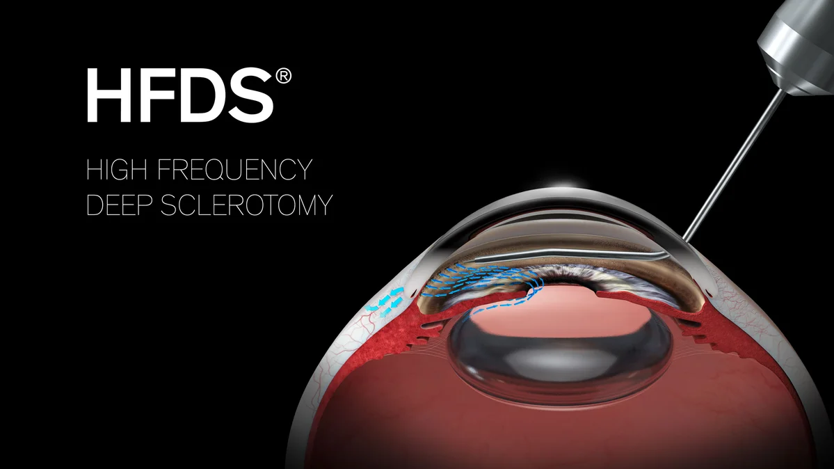 Oertli Blog | Glaucoma & HFDS - a love story