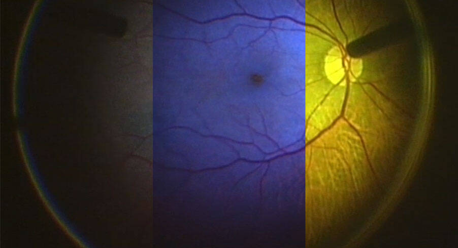 Illumination | Ophthalmology | OS 4