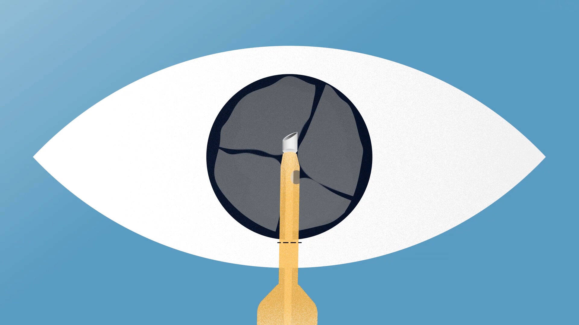 Oertli Blog | Phaco | A revolution in cataract surgery