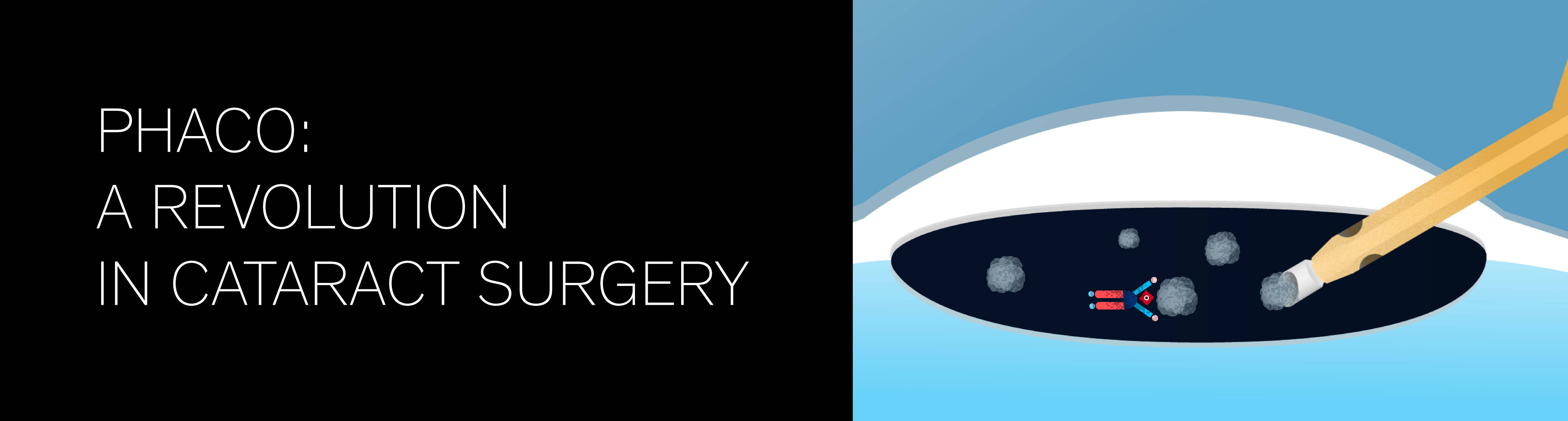 Oertli Blog | Phaco | A revolution in cataract surgery