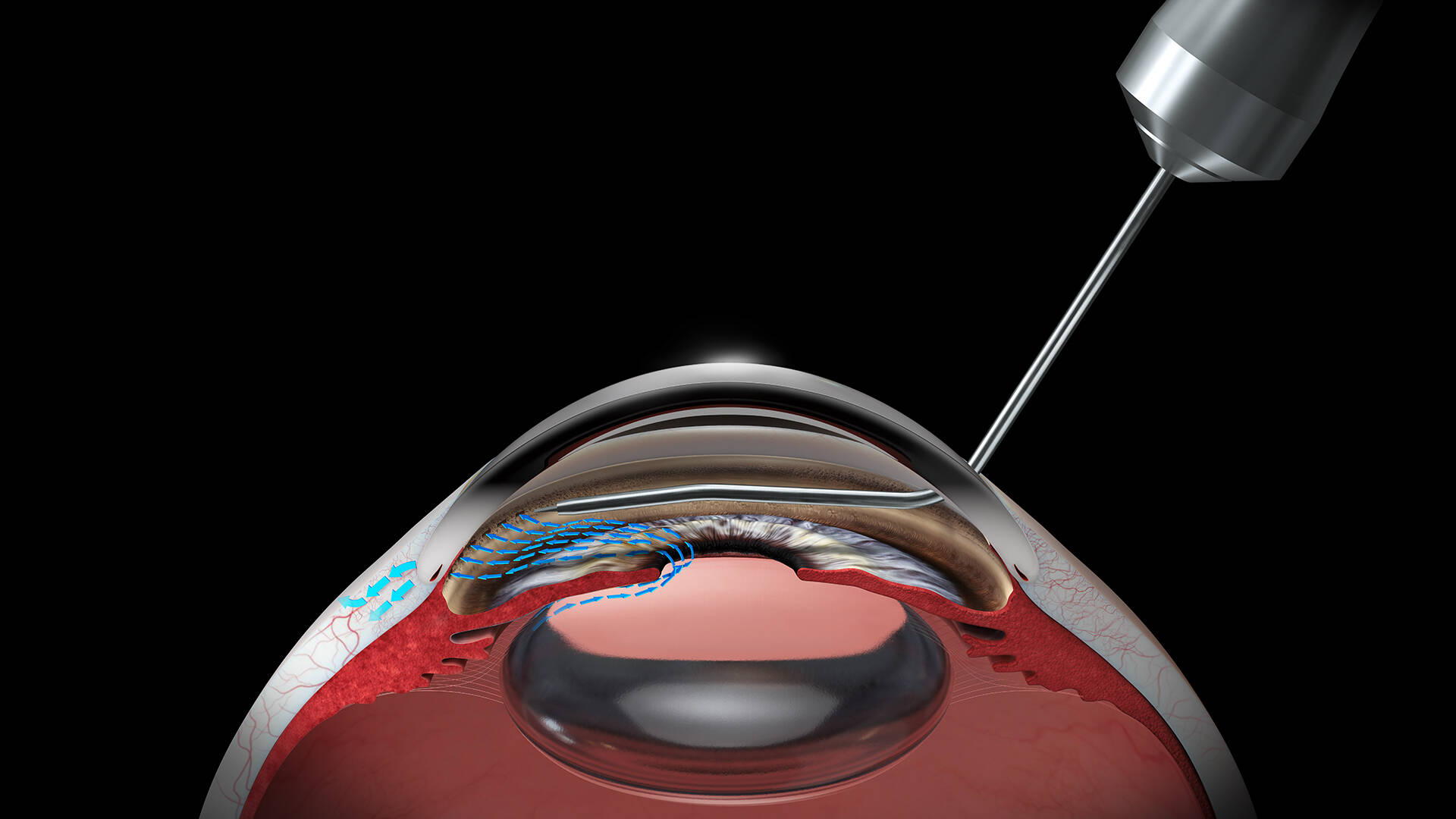 CataRhex 3 | Surgical platform for Ophthalmologists | Oertli Instrumente AG